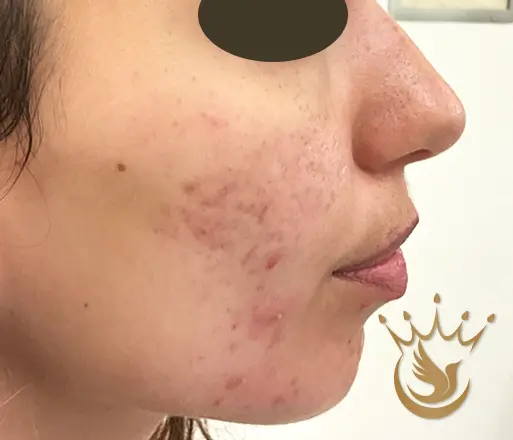 Achieve Youthful Skin With Resurfx Laser Dr R Mokbel Clinic
